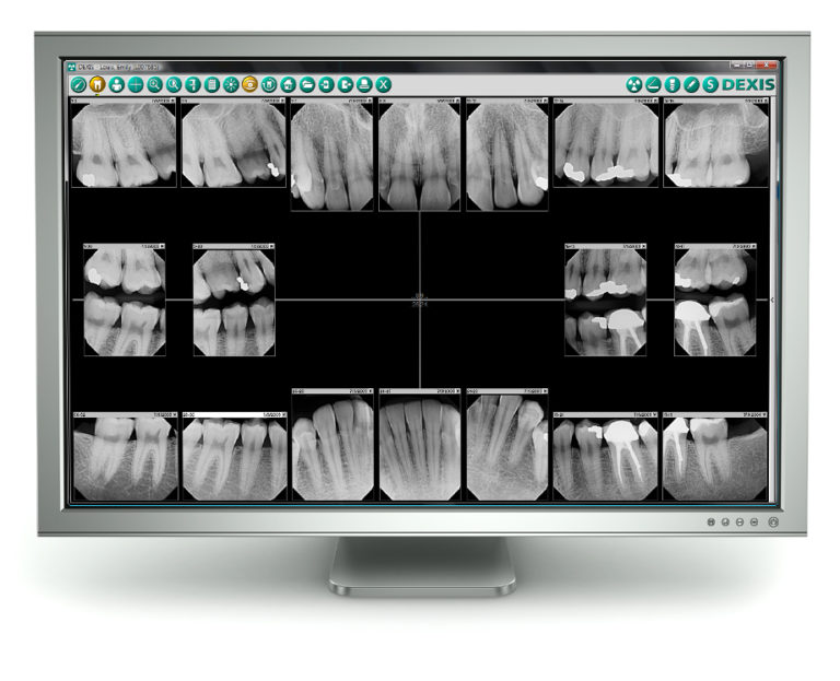 Digital Dental X-Rays | Brian Homann, DDS